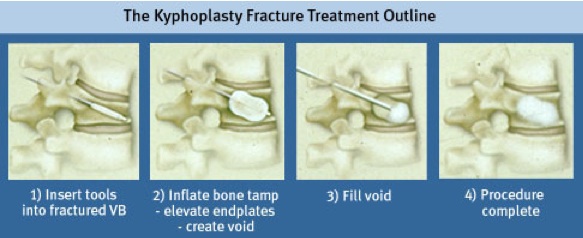 vertebroplasty kyphoplasty - Preferredpaincenter