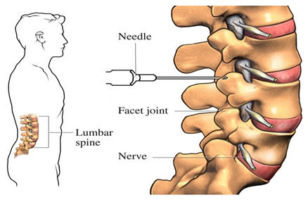 facet arthritis - Preferredpaincenter