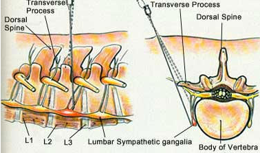 lumbar sympathetic block - Preferredpaincenter